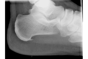 How to diagnose plantar fasciitis | plantar fasciitis diagnosis