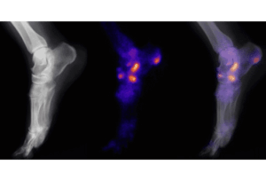 How to diagnose plantar fasciitis | plantar fasciitis diagnosis